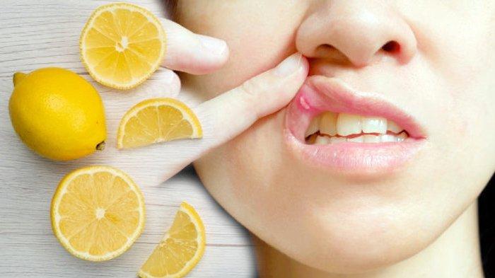 Mengatasi Sariawan: Penyebab, Gejala, dan Cara Pengobatan Efektif ...